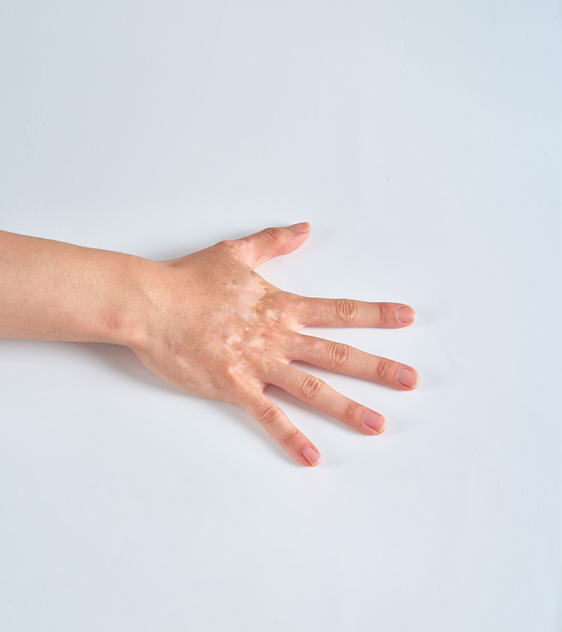 색소 케어 솔루션 리멜라